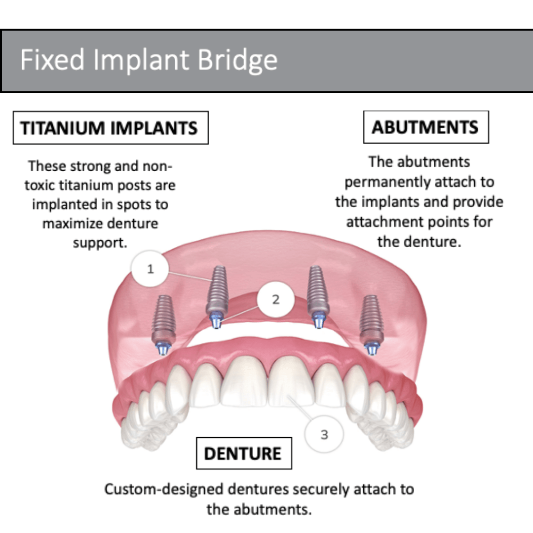 FIXED IMPLANT BRIDGE | YYC Denture Clinic